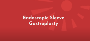 Endoscopic Sleeve Gastroplasty (ESG) | Bariatric Endoscopy TB