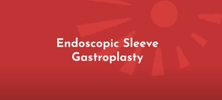 Endoscopic Sleeve Gastroplasty ESG - Bariatric Endoscopy Tampa Bay